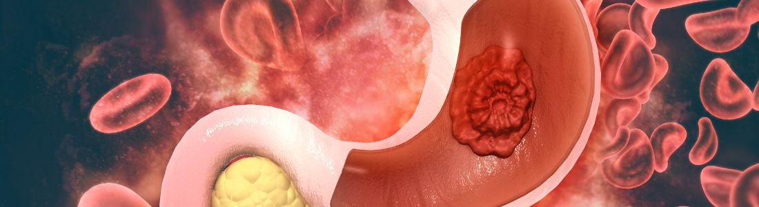 Καρκίνος Στομάχου | Συμπτώματα, Αίτια, Διάγνωση, Θεραπεία